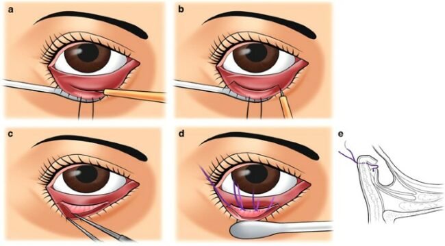 Entropion Correction - KANHAIYALAL VINODKUMARI MEMORIAL EYE HOSPITAL